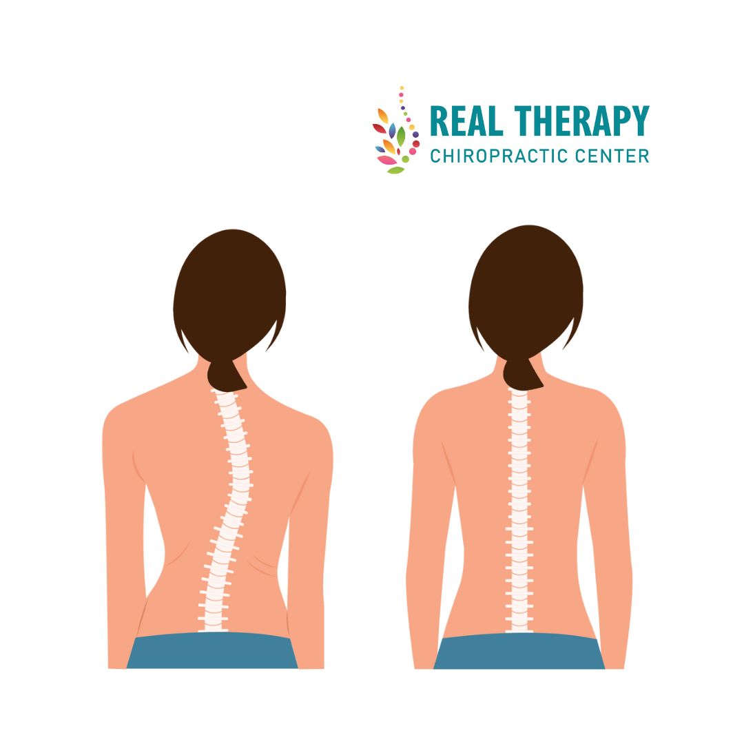 Θεραπεία Σκολίωσης - Scoliosis Treatment